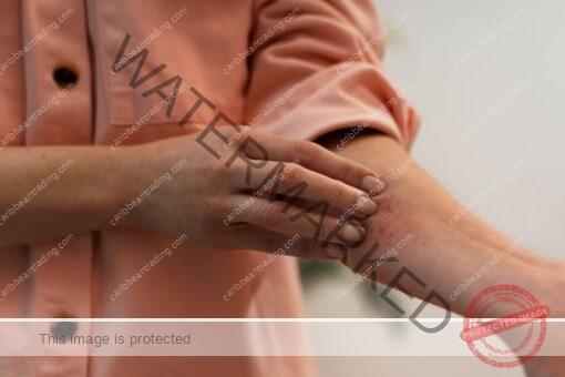 Hives Symptoms and Tropical Food Triggers in the Caribbean